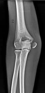 Medial Epicondyle Avulsion Fractures – LOIY ALKHATIB, MD