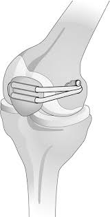 Patellar Instability Surgery – LOIY ALKHATIB, MD